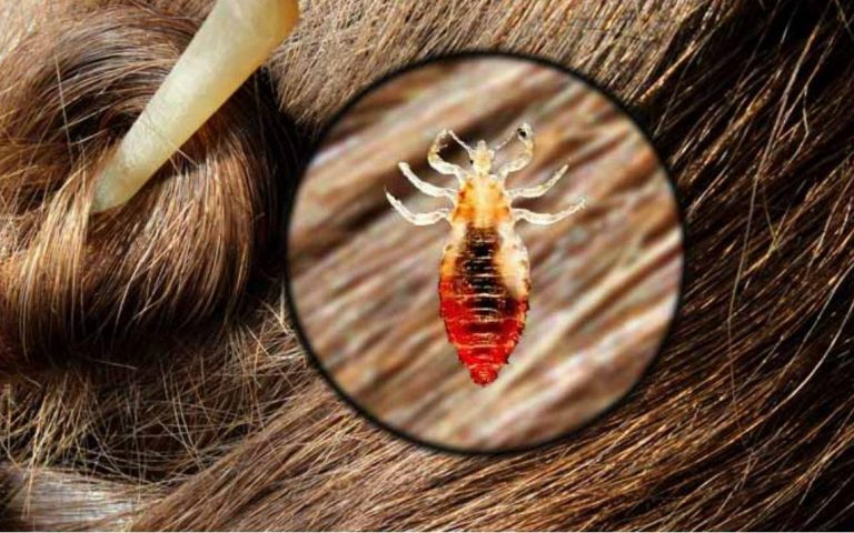 Paduchi de cap: cele mai bune tratamente si remedii pentru copii/adulti