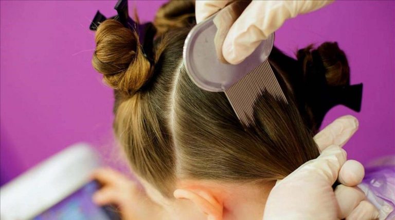 Paduchi de cap: cele mai bune tratamente si remedii pentru copii/adulti